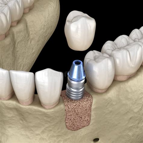 Augmentation Surgery Adding New Bone 3d Illustration Stock