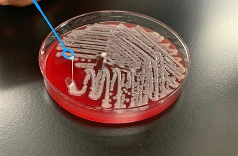 Vibrio Cholerae