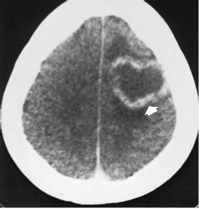 On Radiology Lymphoma In The Brain Of Transplant Recipient Paient