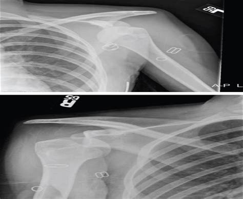 Bilateral Anterior Shoulder Dislocation Jaapa