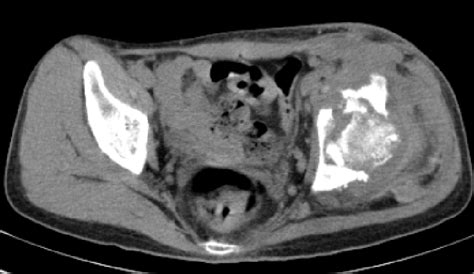 Male 39 Years Old Left Acetabular Defect Type Iiib Anterosuperior