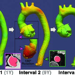 Representative Vascular Deformation Mapping Vdm Assessment Of A