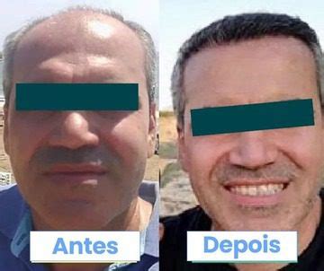 Remédio Natural para Calvície Calvície Tratamento Natural