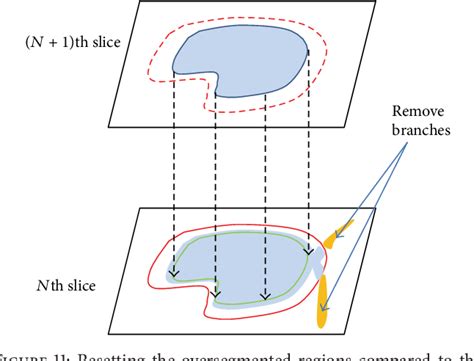 Figure 11 From Fast And Accurate Semiautomatic Segmentation Of Individual Teeth From Dental Ct
