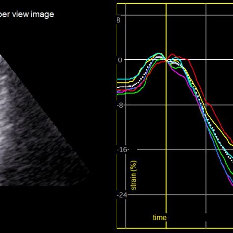 Left Ventricle Peak Longitudinal Strain Measures Generated From Apical