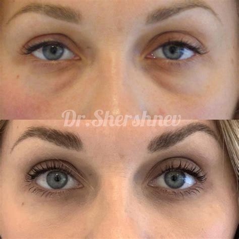 Blefaroplastia Superior e Inferior Cómo Rejuvenecer tu Mirada con