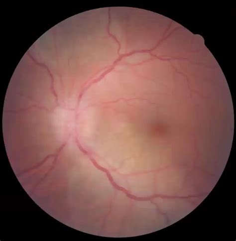 The Great Imitator Retinal Manifestations Of Ocular Syphilis