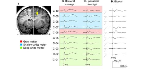 Cortico Cortical Evoked Potentials Cceps Measured On Different Download Scientific Diagram