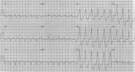 心电图挑战宽窄 QRS 并存的心律失常 学术动态 医心网