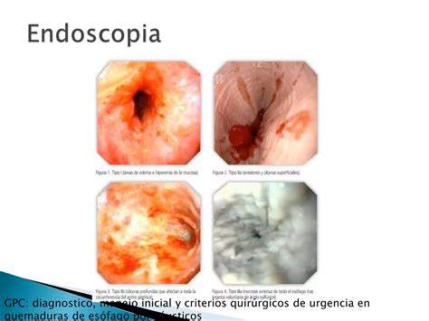 Esofagitis Caustica Y Sus Complicaciones Ppt