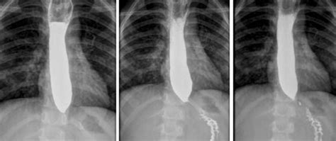 Timed Barium Esophagram Predicts Aspiration Risk Post Poem
