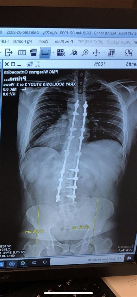 Heres My Most Recent X Ray Of My Herrington Rods Had Surgery At 18 In