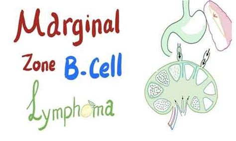 Management Of Marginal Zone Lymphomas Updated Esmo Guidelines