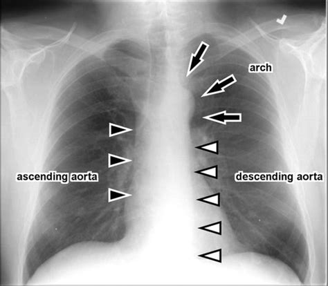 Aortic Dissection X Ray