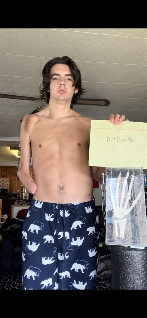 25 M Disabled Tbi Sci Tbpi Amputee Spine Surgery A Few Arm