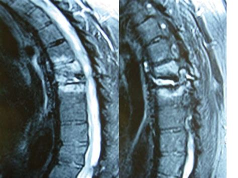 Dish Diffuse Idiopathic Skeletal Hyperostosis Of The Spine