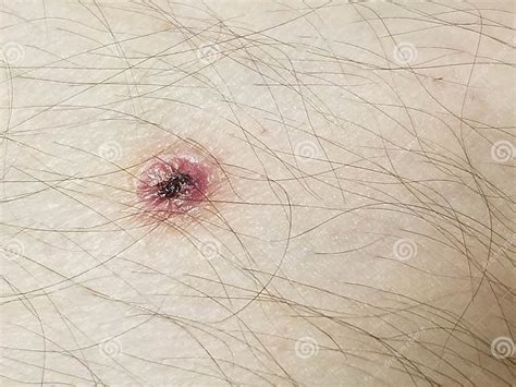 Pyoderma Gangrenosum On Leg Of Patient With Ulcerative Colitis Stock