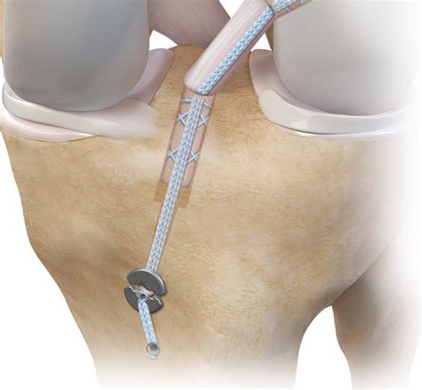 Arthrex Tightrope® Ii Attachable Button System