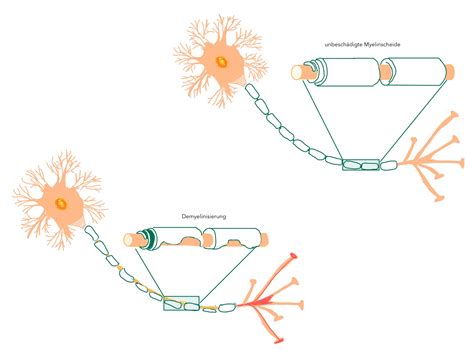 Neurophysiologie Multiple Sklerose Eine gefährliche Nervenkrankheit
