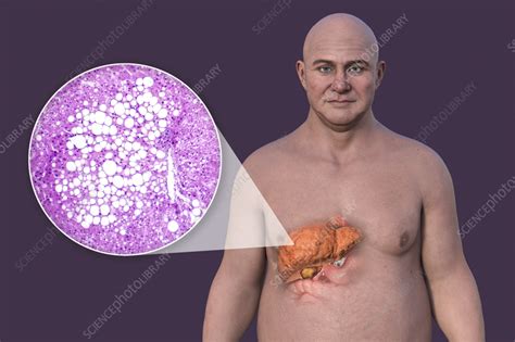 Fatty Liver Illustration Stock Image F0436029 Science Photo Library