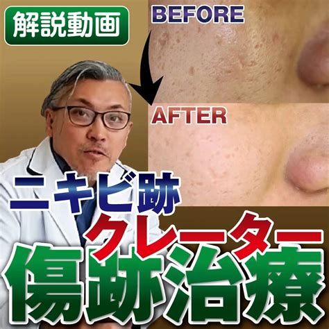 スマイルクリニック新宿 公式 ニキビあとのクレーターは、炎症の繰り返しによって生じた傷跡組織の拘縮と組織不足によって、目に見えるくぼみに