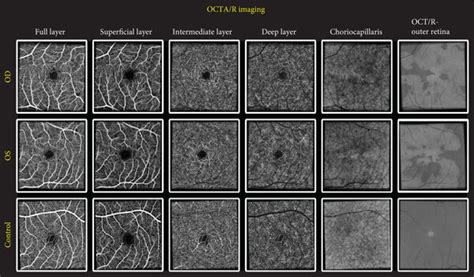 Optical Coherence Tomography Angiography Oct A Of Both Eyes Compared Download Scientific