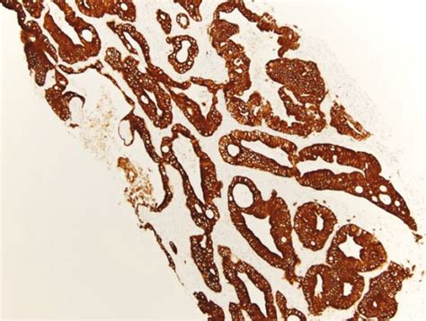 A Histologic Sections Of The Needle Core Biopsy Of A Right Lower Lobe