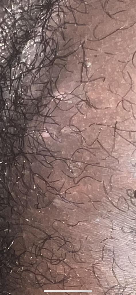 Are These Folliculitis Rfolliculitis