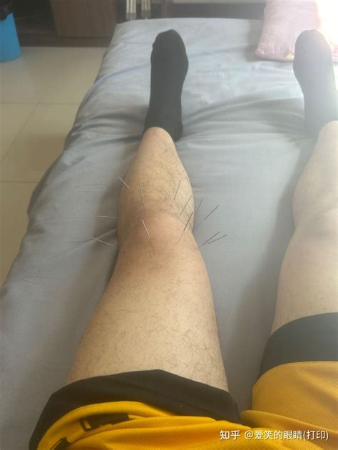 Mri检查结果：左侧膝关节对应关系可，间隙存在，髌骨内、外侧支持带未见异常信号，左胫骨外侧髁、胫骨外侧平台见斑片状稍长t1、pd抑制像呈稍高