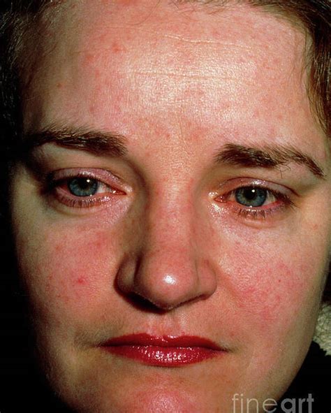 Facial Rash Of Systemic Lupus Erythematosus Sle Poster By Dr Hcrobinsonscience Photo