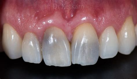 Internal Tooth Bleaching Whitening Teeth From Inside