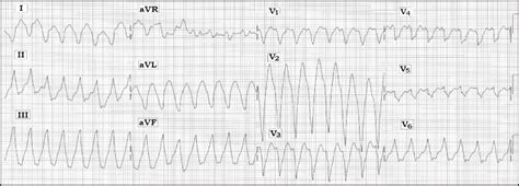 Ecg Review Why Is The Rhythm Vt 2012 10 01 Ahc…