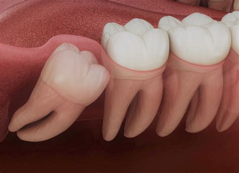 Dente Do Siso O Que é E Quanto Custa Para Extrair