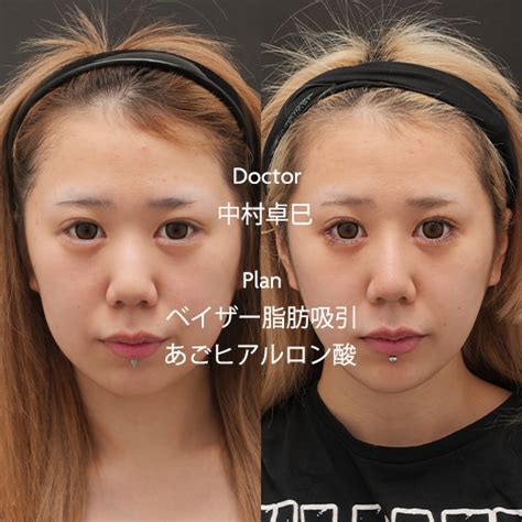 ベイザー脂肪吸引の症例写真一覧 顔の脂肪吸引なら東京イセアクリニック東京・新宿