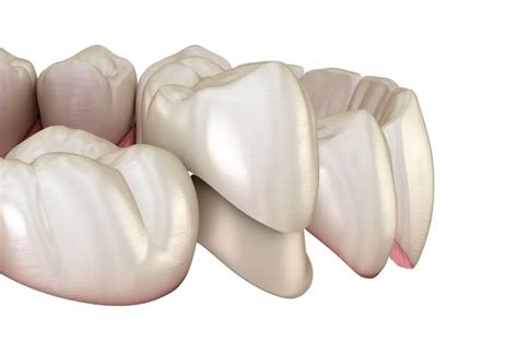 Dental Crowns Birmingham Dental Crown Fitting