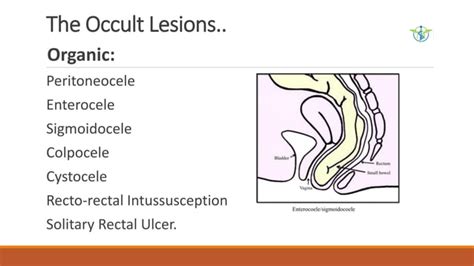 Obstructed Defecation Syndrome Ppt
