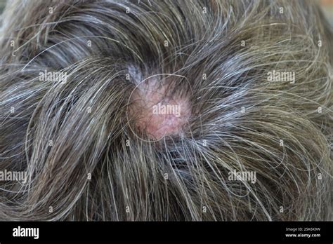 Lymph Node Cancer Light Micrograph Stock Photo Alamy