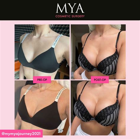Boob Job Recovery Help Mya Cosmetic Surgery
