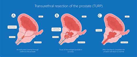 Transurethral Resection Of The Bladder