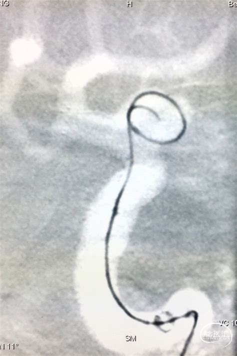 颅内动脉瘤微导管塑形演义（六） 脑医汇