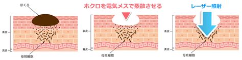 ほくろ除去（保険適応可能） 神奈川県横浜市港北区新横浜のtjクリニック