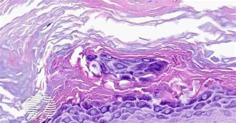 Hypergranulotic Dyscornification Image