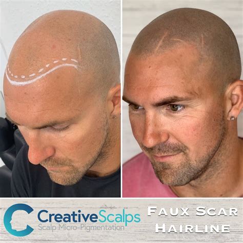 Adding A Faux Scar Into Your Scalp Micropigmentation Smp