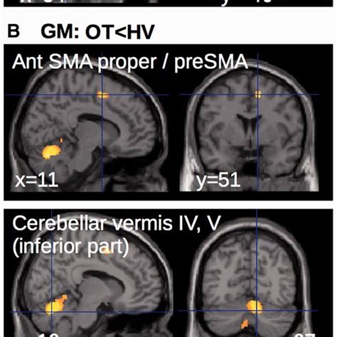 Group Differences In Voxel Based Morphometry Statistical Parametric
