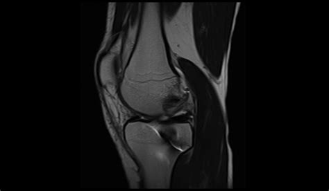 Mars Mri Metal Artifact Reduction Mri