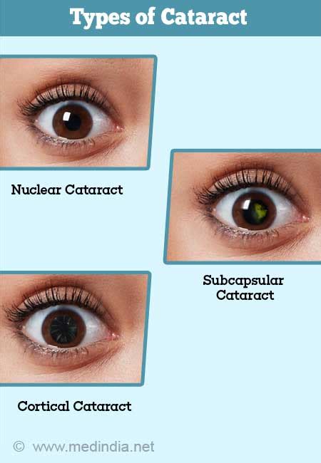 Cataract Is Caused By