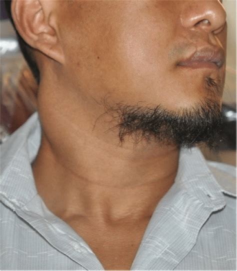 Swollen Lymph Nodes Hiv