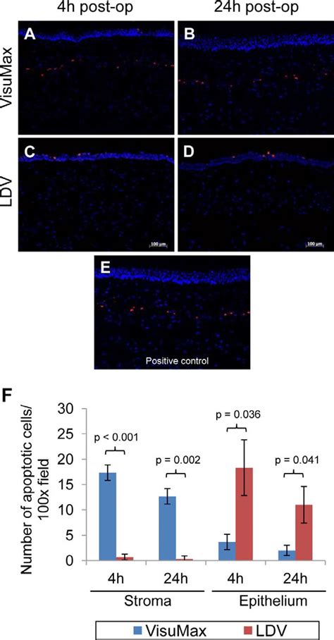 Detection Of Apoptotic Cells By TUNEL Assay In The Central Cornea After