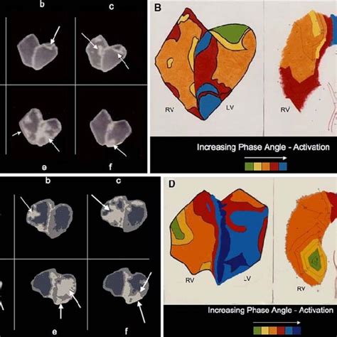 Phase And Isochronous Epicardial Maps Shown Are Serial Phase Images