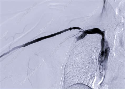 Treatment For Blocked Arteries Angiogram Stock Image F0377244